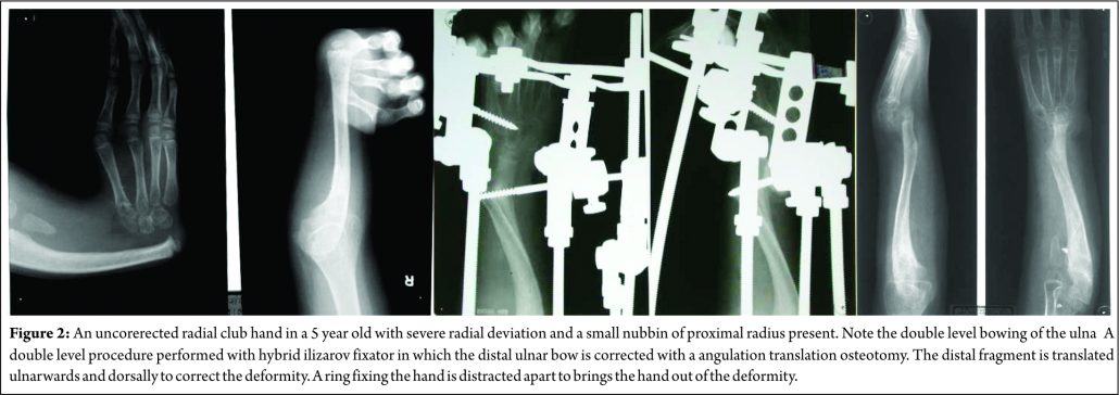 The Use of Distraction Techniques in Treating Radial Clubhand ...