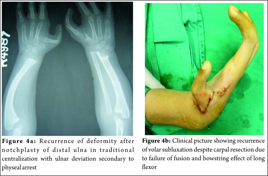 Complications of Surgical Management of Radial Club Hand ...