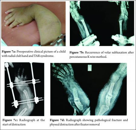Complications of Surgical Management of Radial Club Hand ...