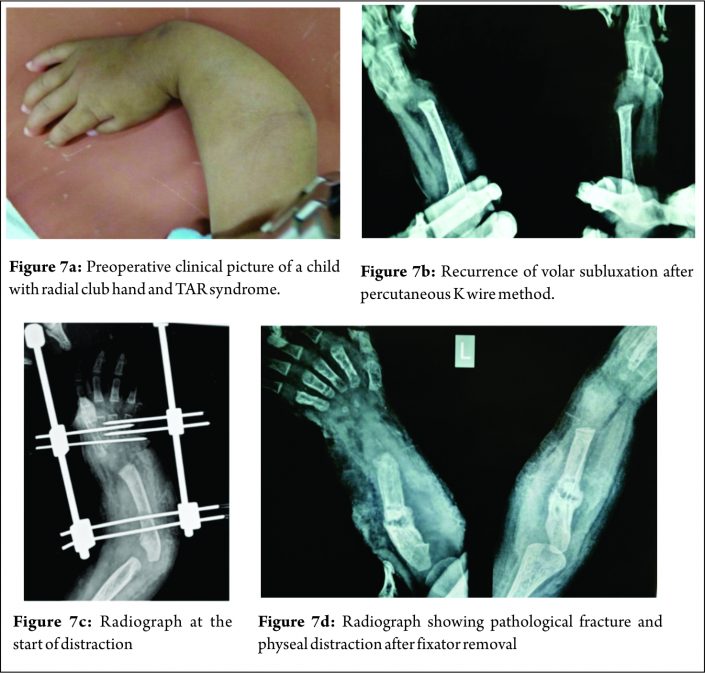 Complications of Surgical Management of Radial Club Hand ...
